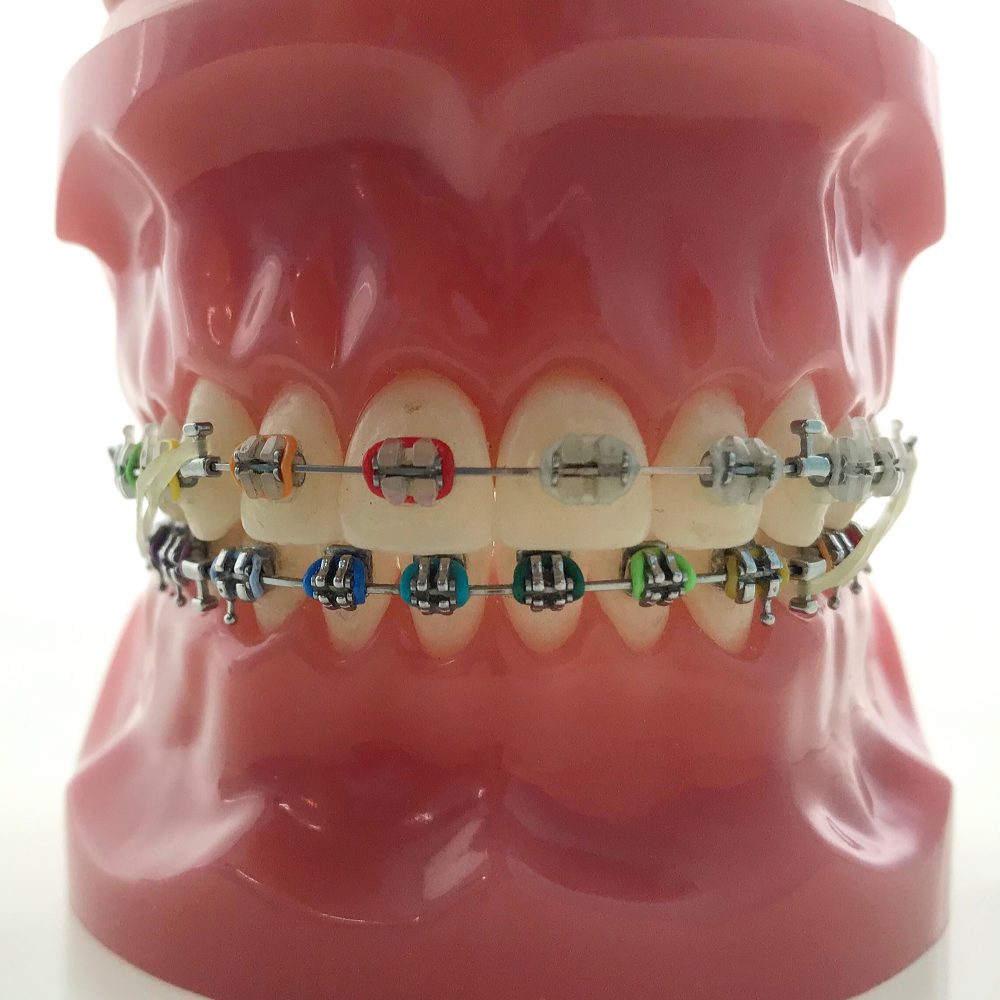 Resources | About Braces