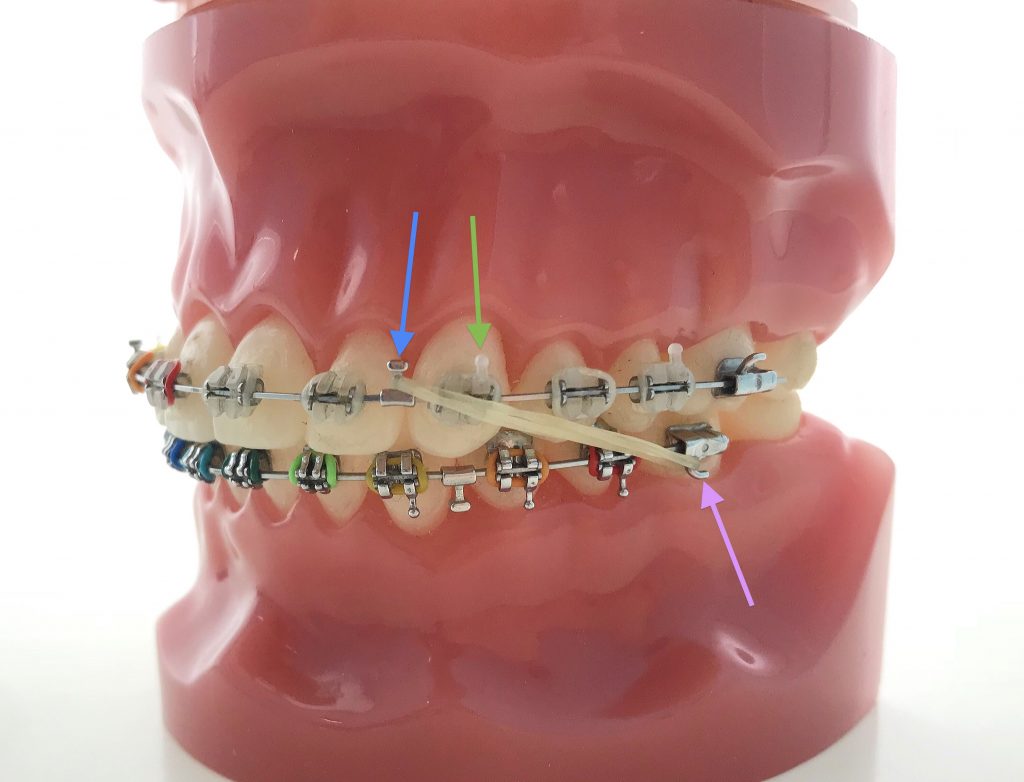CLASS II ELASTICS | About Braces