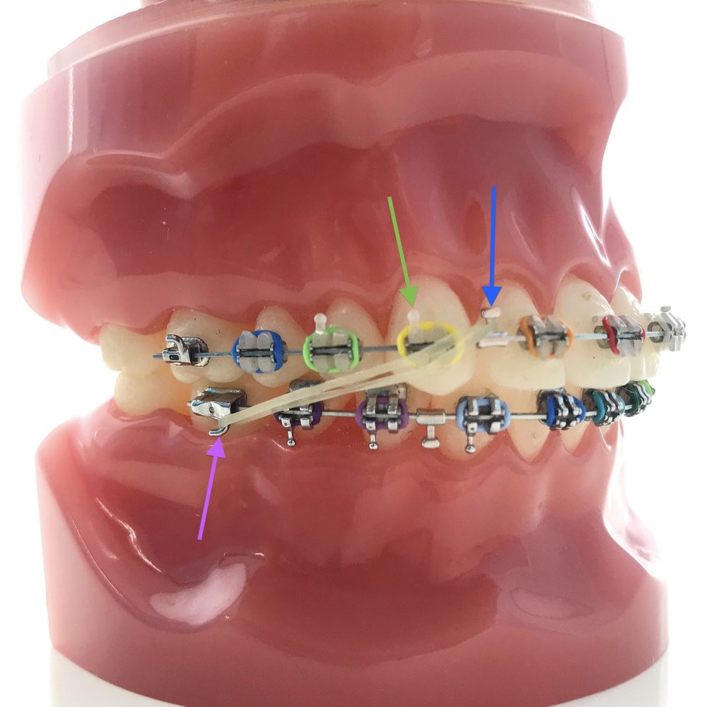 Resources | About Braces