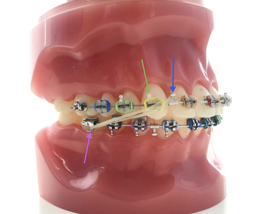 CLASS II RIGHT CLASS III LEFT ELASTICS | About Braces