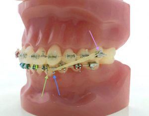 CLASS III ELASTICS | About Braces