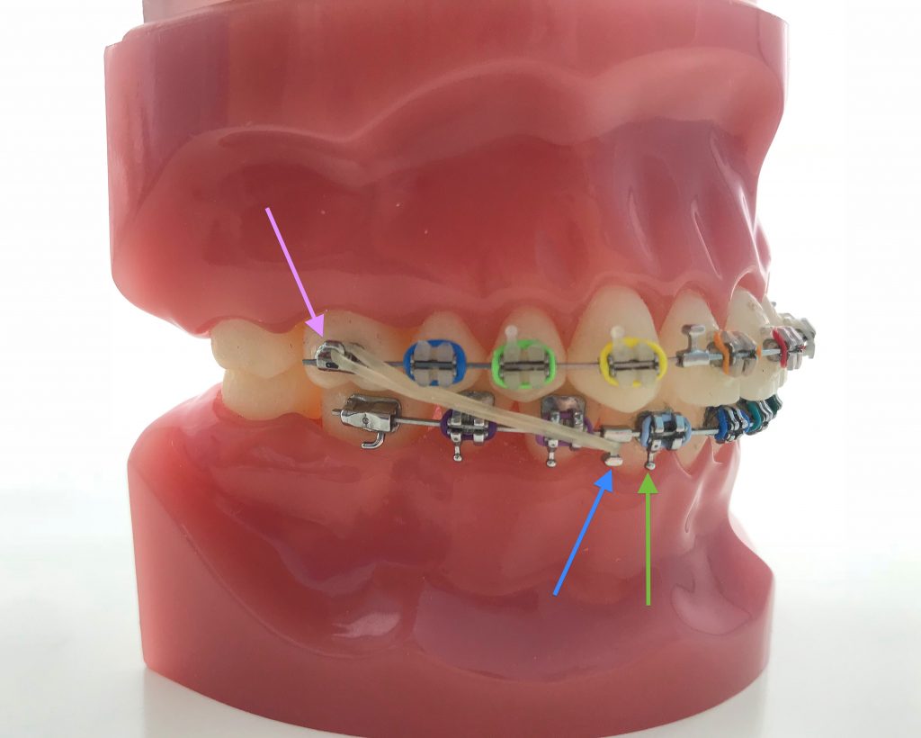 CLASS II LEFT CLASS III RIGHT ELASTICS | About Braces