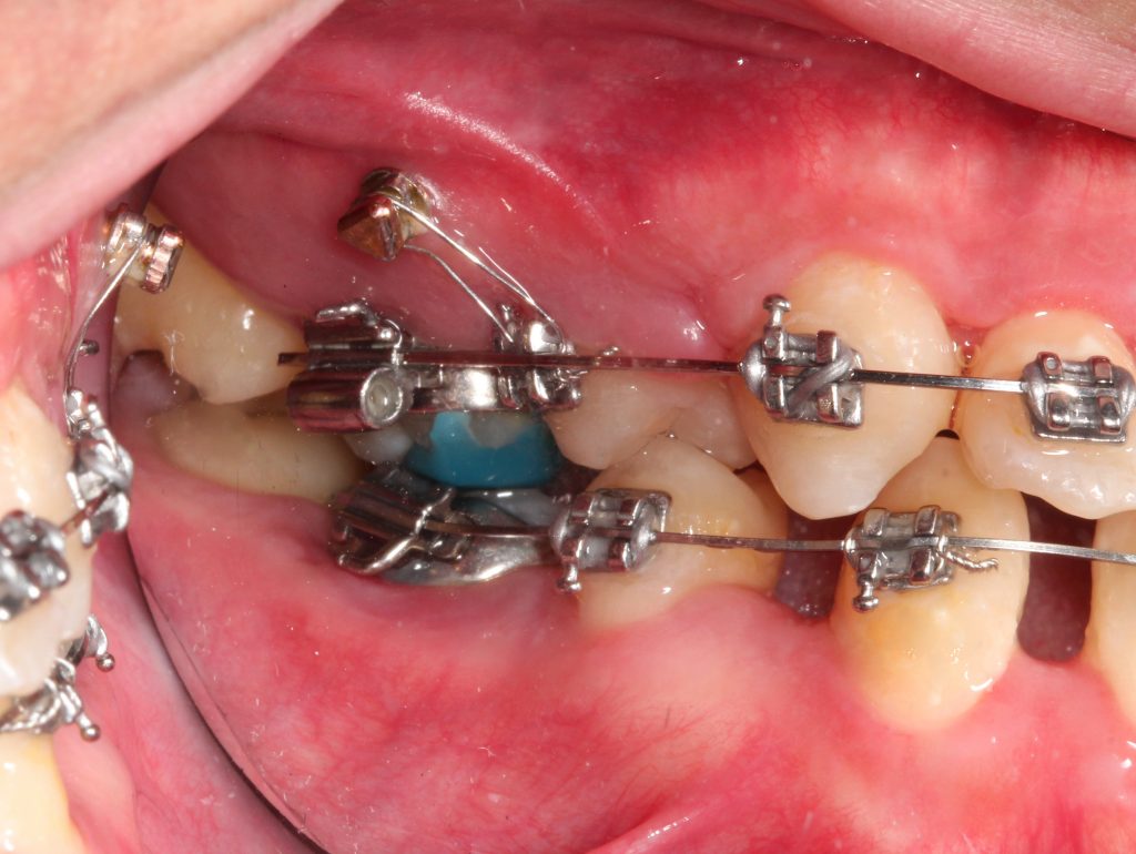 BRACES SINGAPORE: EXTRACTION VS. NON-EXTRACTION | About Braces