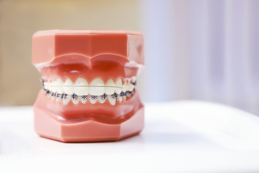 Everything You Need to Know about Ceramic Braces